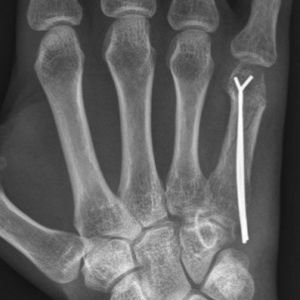 Brüche der Finger- und Mittelhandknochen, Behandlung | KSW