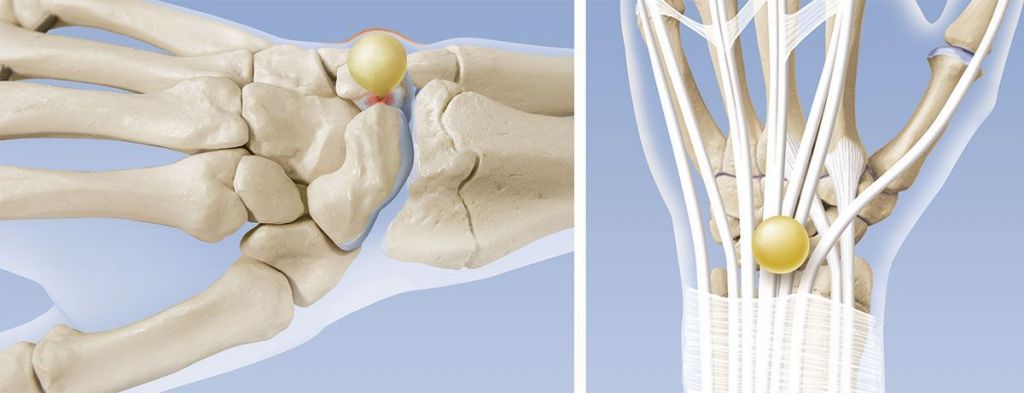 Handgelenksganglion - Ursachen und Behandlung | KSW