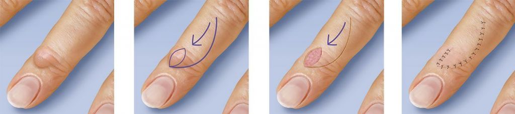 Mukoidzyste - Ursachen, Symptome, Behandlung | KSW