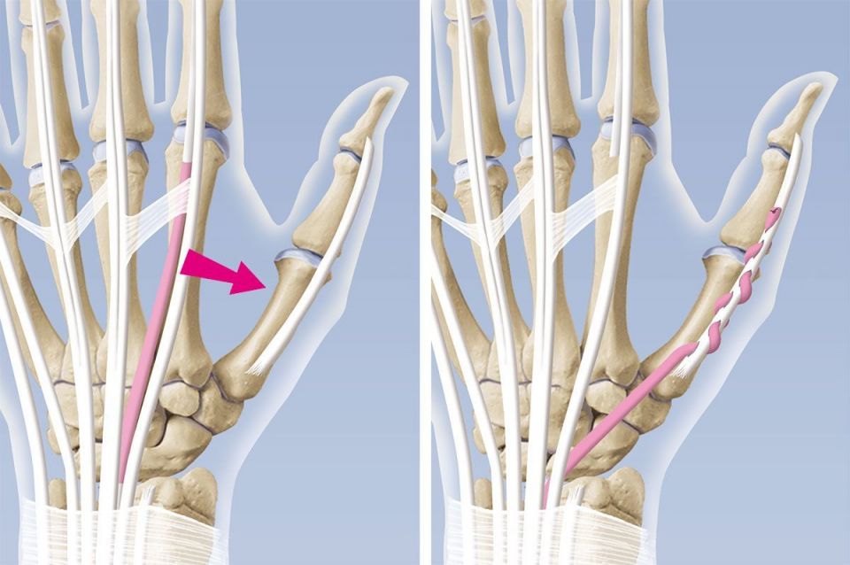 EPL-Ruptur / Riss der langen Daumenstrecksehne - KSW