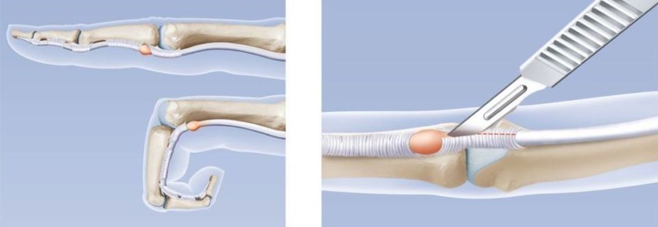 Schnellender Finger / Schnappfinger - Behandlung | KSW