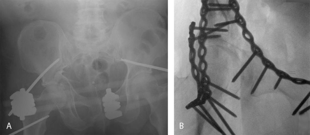 Beckenbruch - Behandlung | Kantonsspital Winterthur KSW