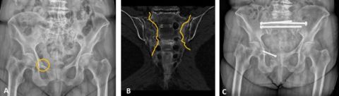 Beckenbrüche / Beckenfrakturen im Alter | KSW
