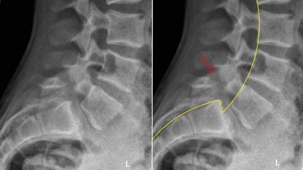 Spondylolyse, Spondylolisthesis, Gleitwirbel | KSW