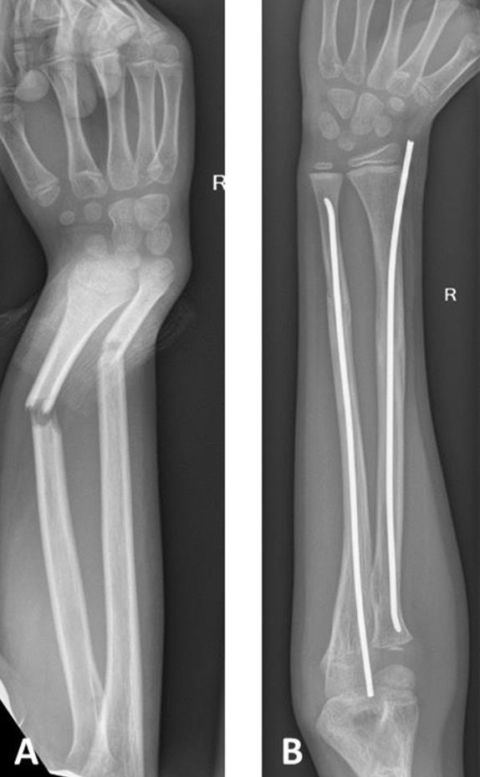 Elastische stabile intramedulläre Nagelosteosynthese | KSW
