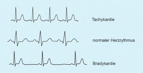 Herzrhythmusstörung / Arrhythmie | Kantonsspital Winterthur