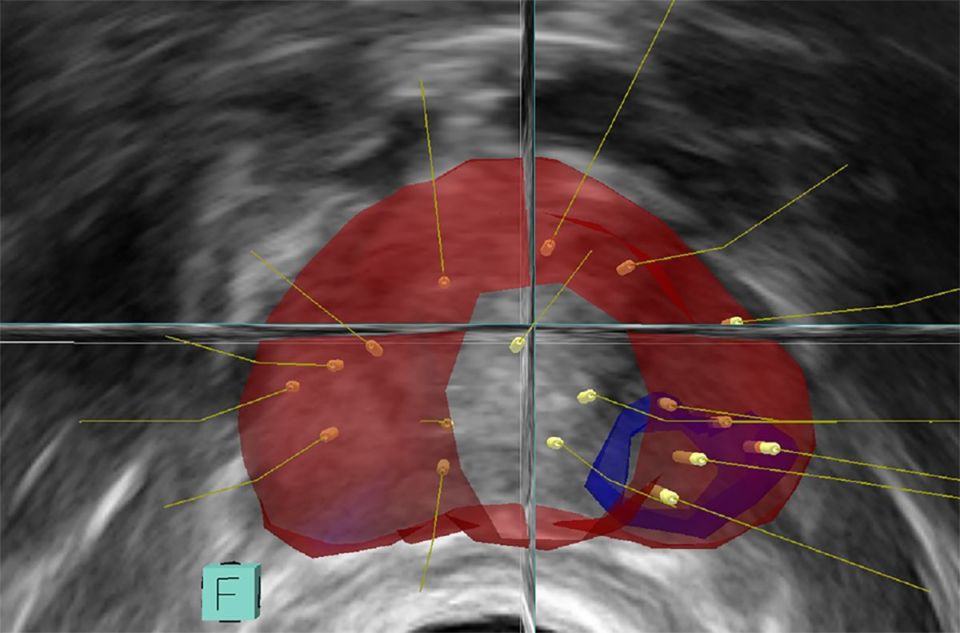 Prostatakrebs / Prostatakarzinom / PCa - Ursache und Behandlung - KSW