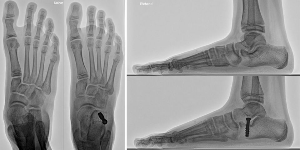 Plattfuss / Knicksenkfuss - Diagnose und Behandlung | KSW