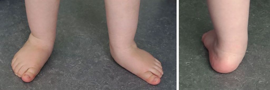 Plattfuss / Knicksenkfuss - Diagnose und Behandlung | KSW