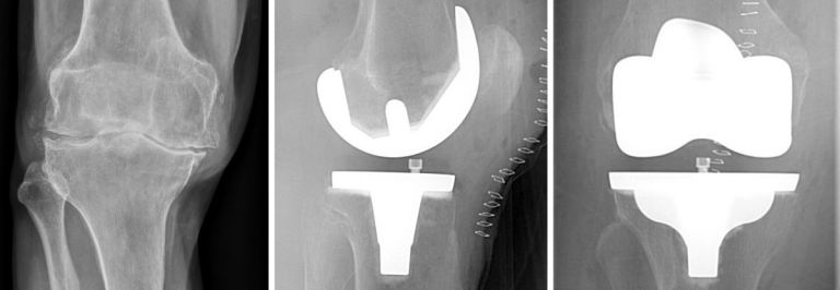 Knieprothese - Operation, Vorgehen und Nachsorge | KSW