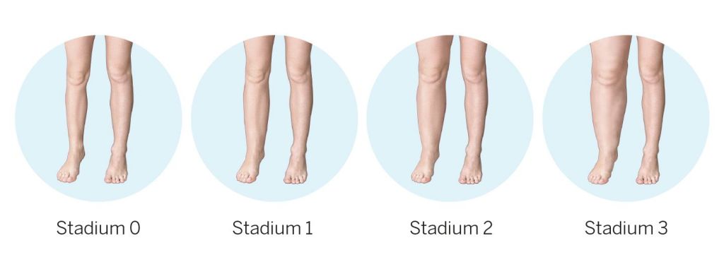 Lymphödem - Ursachen und Behandlung | Kantonsspital Winterthur