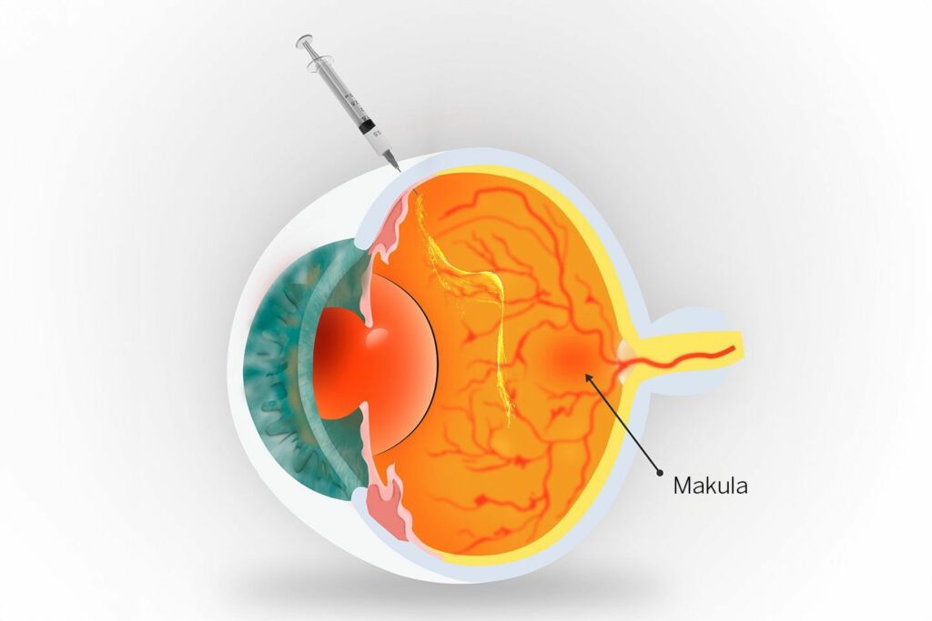 Makulazentrum, Intravitreale Injektionen - Augenklinik | KSW