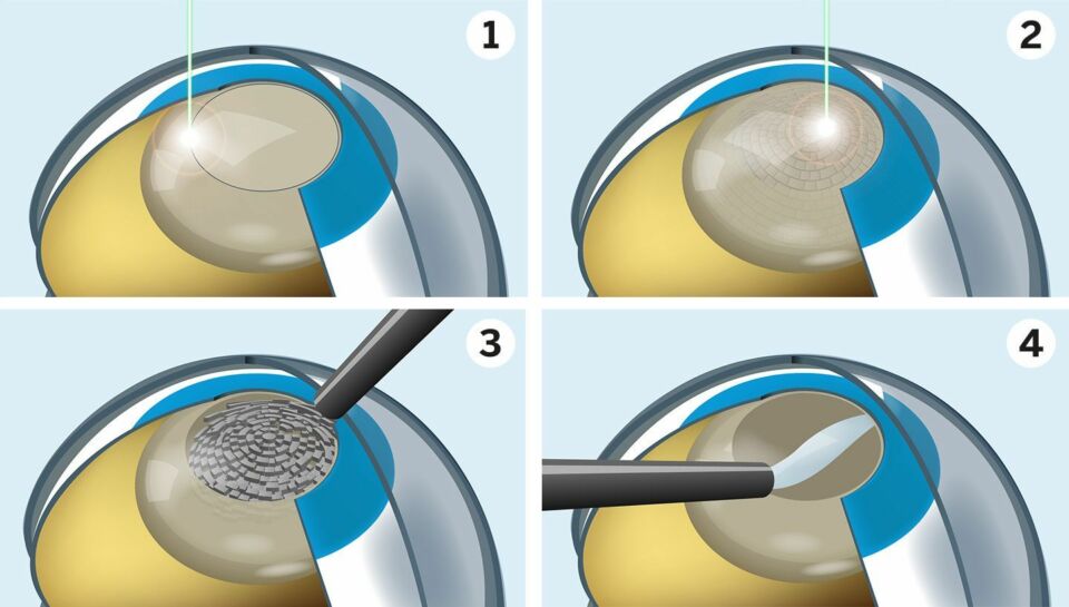Refraktiver Linsenaustausch - Augenklinik | KSW