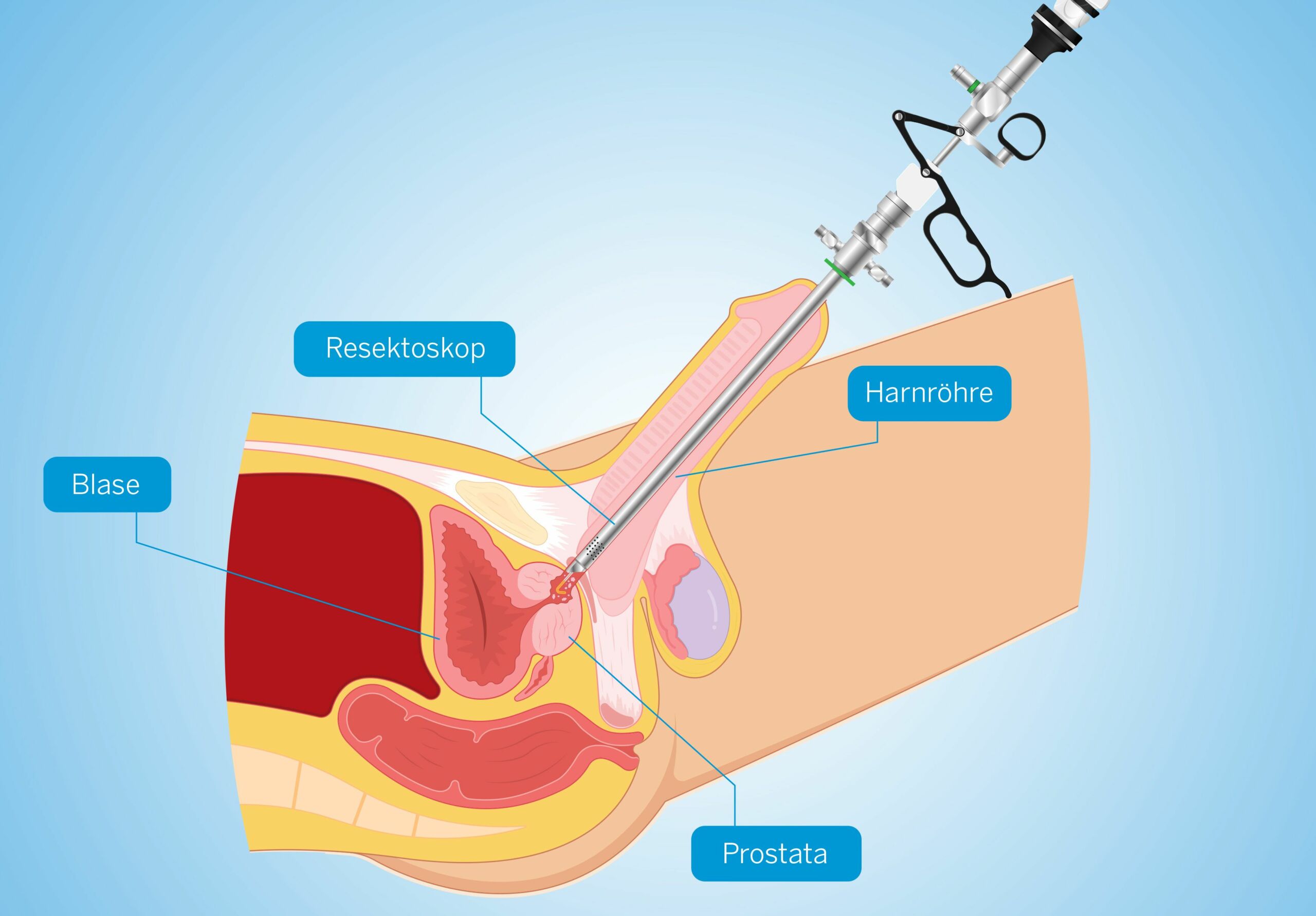 Transurethrale Resektion der Prostata TUR-P | KSW