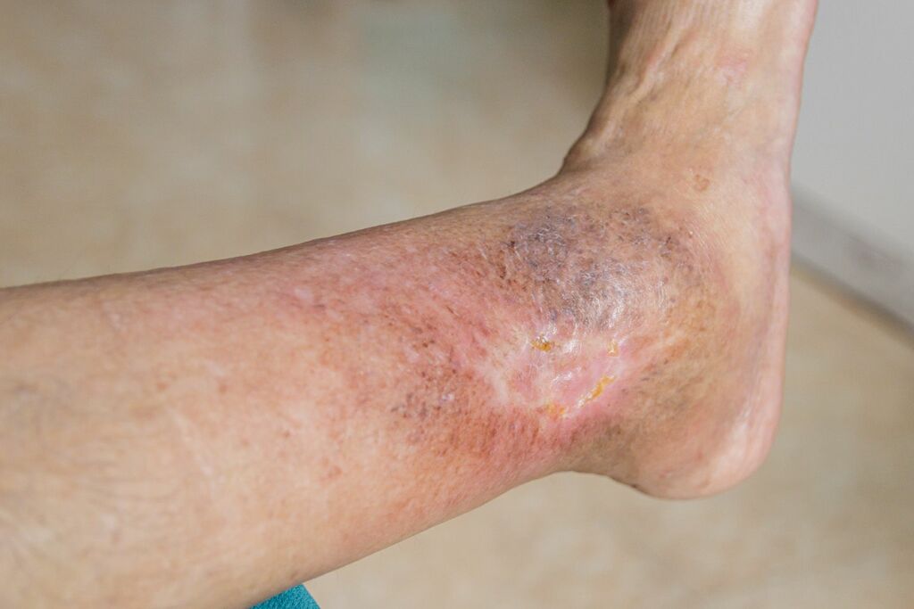 Offenes Bein / Ulcus cruris - Diagnose und Behandlung | KSW