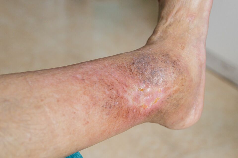 Offenes Bein / Ulcus cruris - Diagnose und Behandlung | KSW